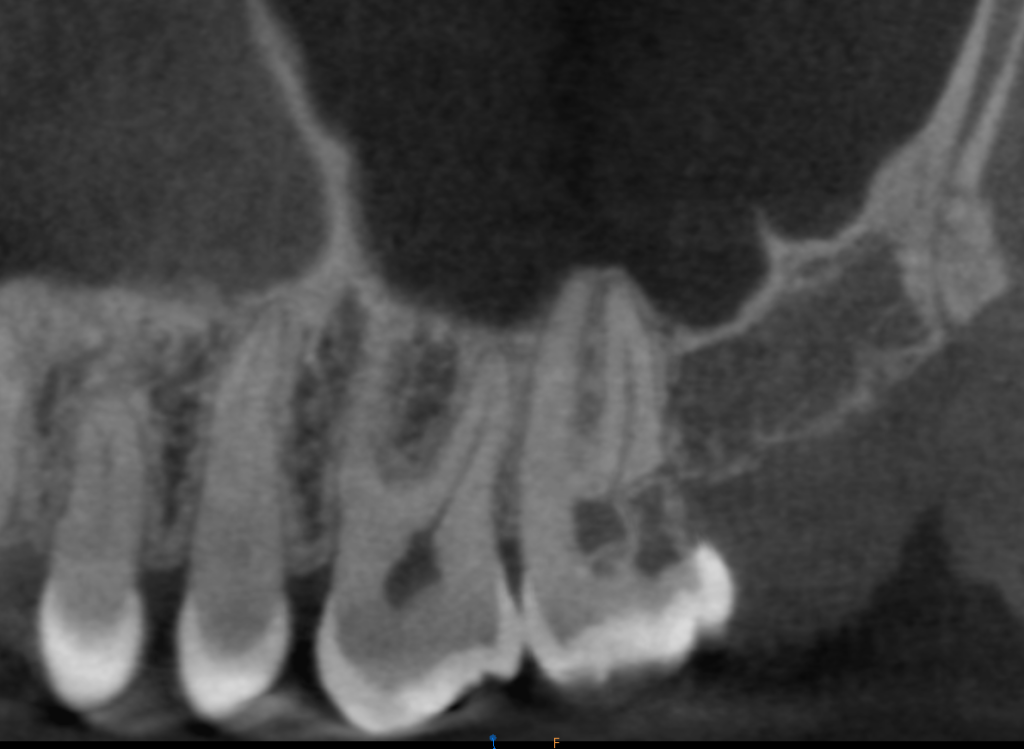 CBCT sagittal view for Oregon Denatl Conference, 2016 - EndoNet Consulting