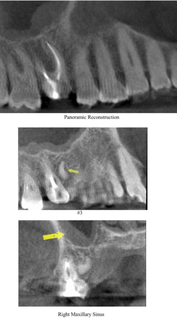 Retained root possibly of #A or idiopathic sclerosis - EndoNet Consulting