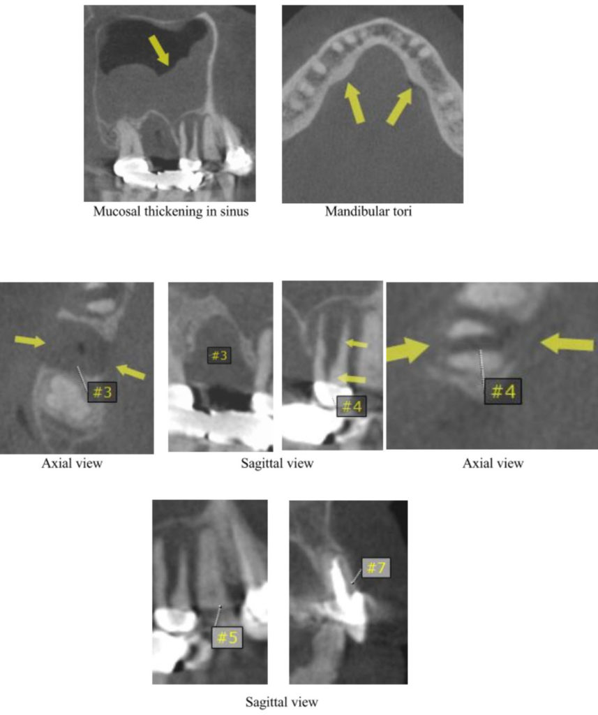 Split root, maxillary right second bicuspid - EndoNet Consulting