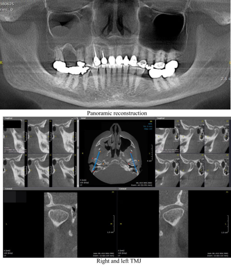 Split root, maxillary right second bicuspid - EndoNet Consulting